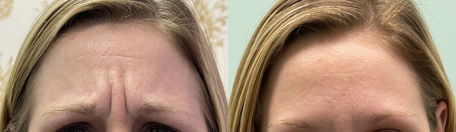 Botox, Patient 1 - LIV Wellness Lounge, Inc