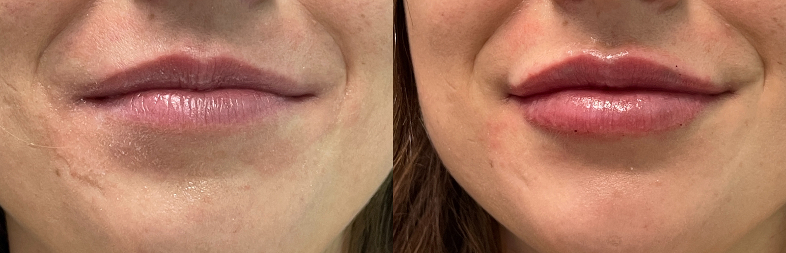 Dermal Fillers in LaSalle - LIV Wellness Lounge