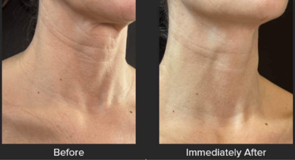 Attiva Treatment - LIV Wellness Lounge, Inc